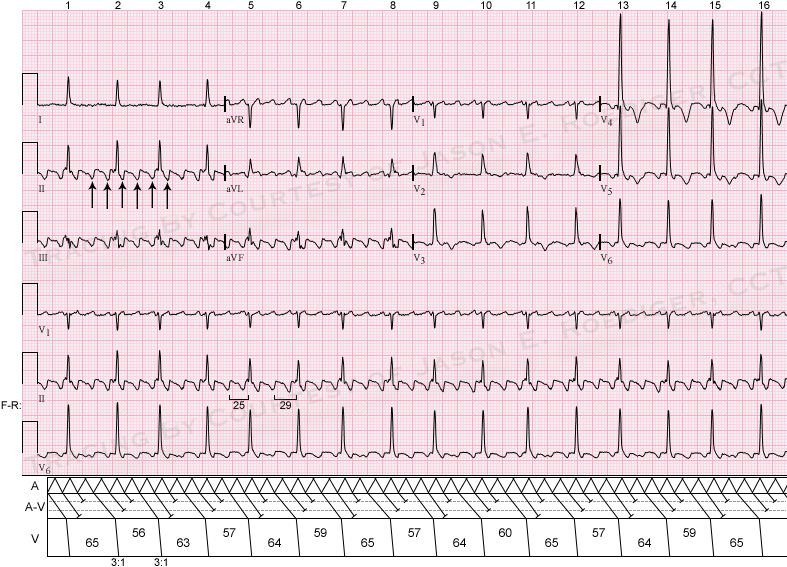 Atrial Flutter With 3 1 A V Conduction Ecg Guru Instructor Resources